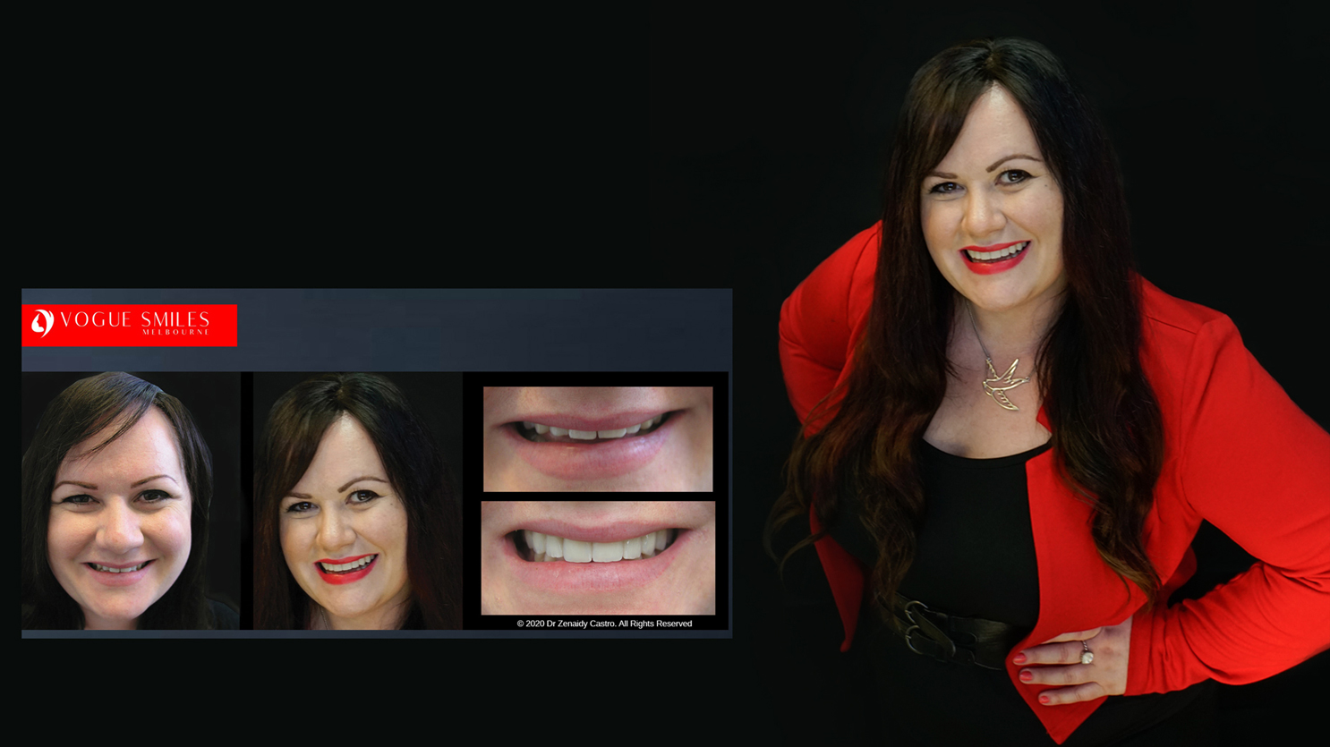 What is Smile Makeover? | VOGUE SMILES MELBOURNE