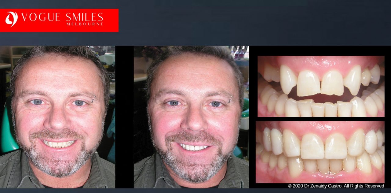 DENTAL BONDING -COMPOSITE RESIN VENEERS