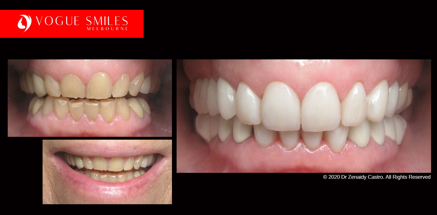 STANDARD VENEER VS NO-PREP VENEER | Melbourne