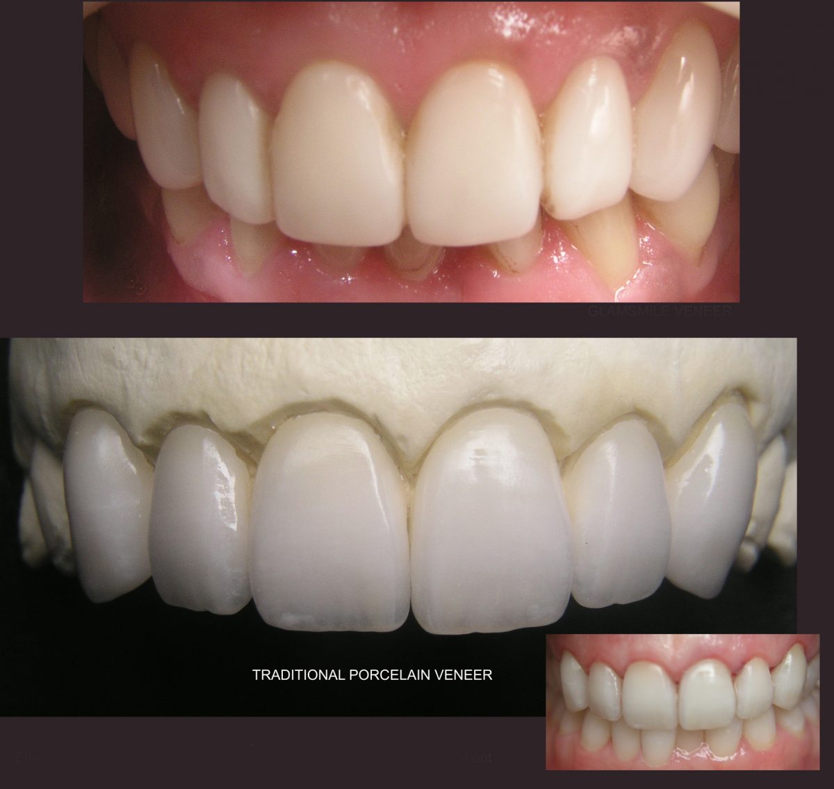 Porcelain Veneers Melbourne FAQ | Vogue Smiles Melbourne